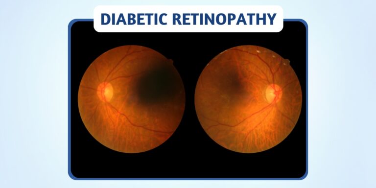 Connection Between Diabetes and Vision: Managing Diabetic Retinopathy ...