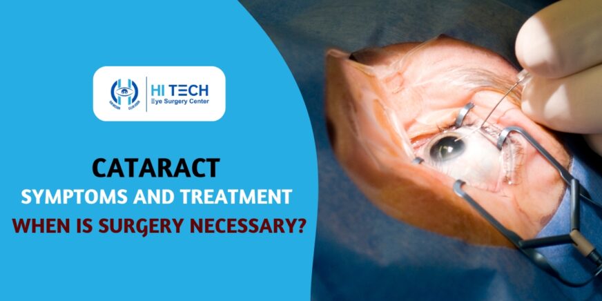 Symptoms and Treatment of Cataract: When is Surgery Necessary? | Hi ...
